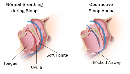 Unveiling The Connection Between Sleep Apnea And Erectile Dysfunction